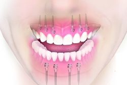 DentalServiceTrade | Imtec Implant Technology